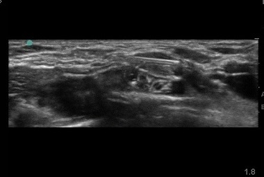 Brachial Plexus Block: BPB | Anesthesiologist - SIFSOF