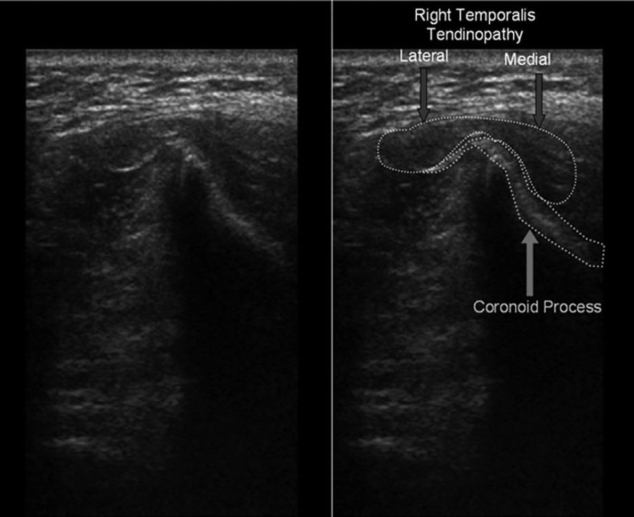 Jaw Muscle Injection (TMJ) - Medical Articles By SIFSOF