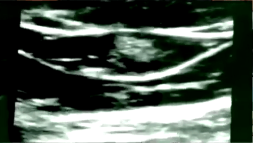 Ultrasound Guided Bbl Surgery Brazilian Butt Lift Sifsof